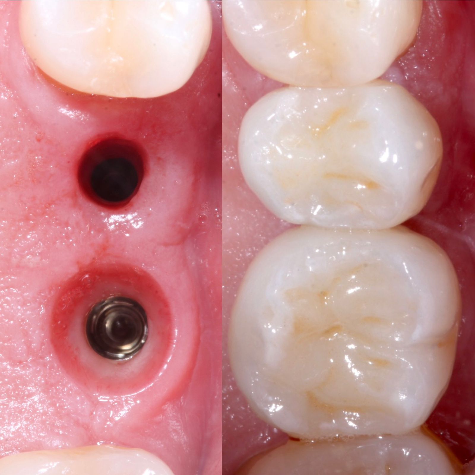 DENTAL IMPLANTS - Baja Oral Center
